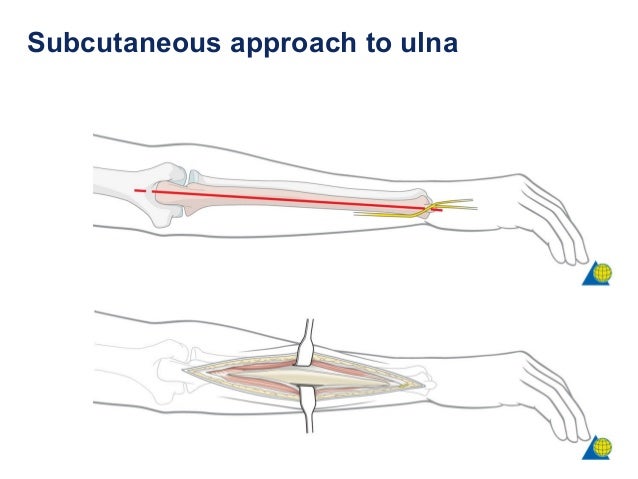 Forearm shaft fractues