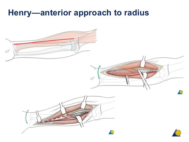 Forearm shaft fractues
