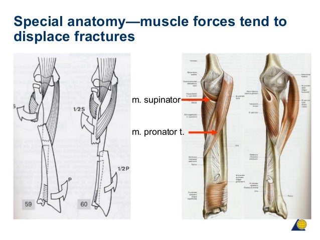 Forearm shaft fractues