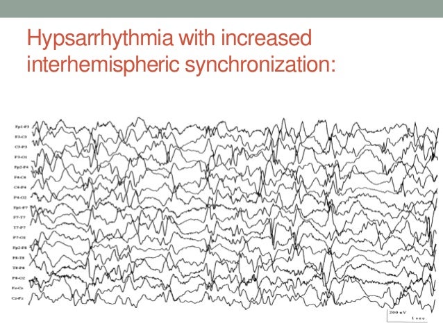 We st syndrome eeg