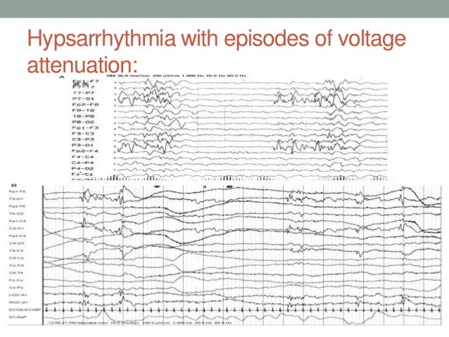 We st syndrome eeg