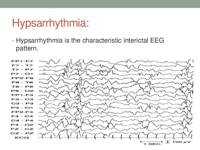 We st syndrome eeg