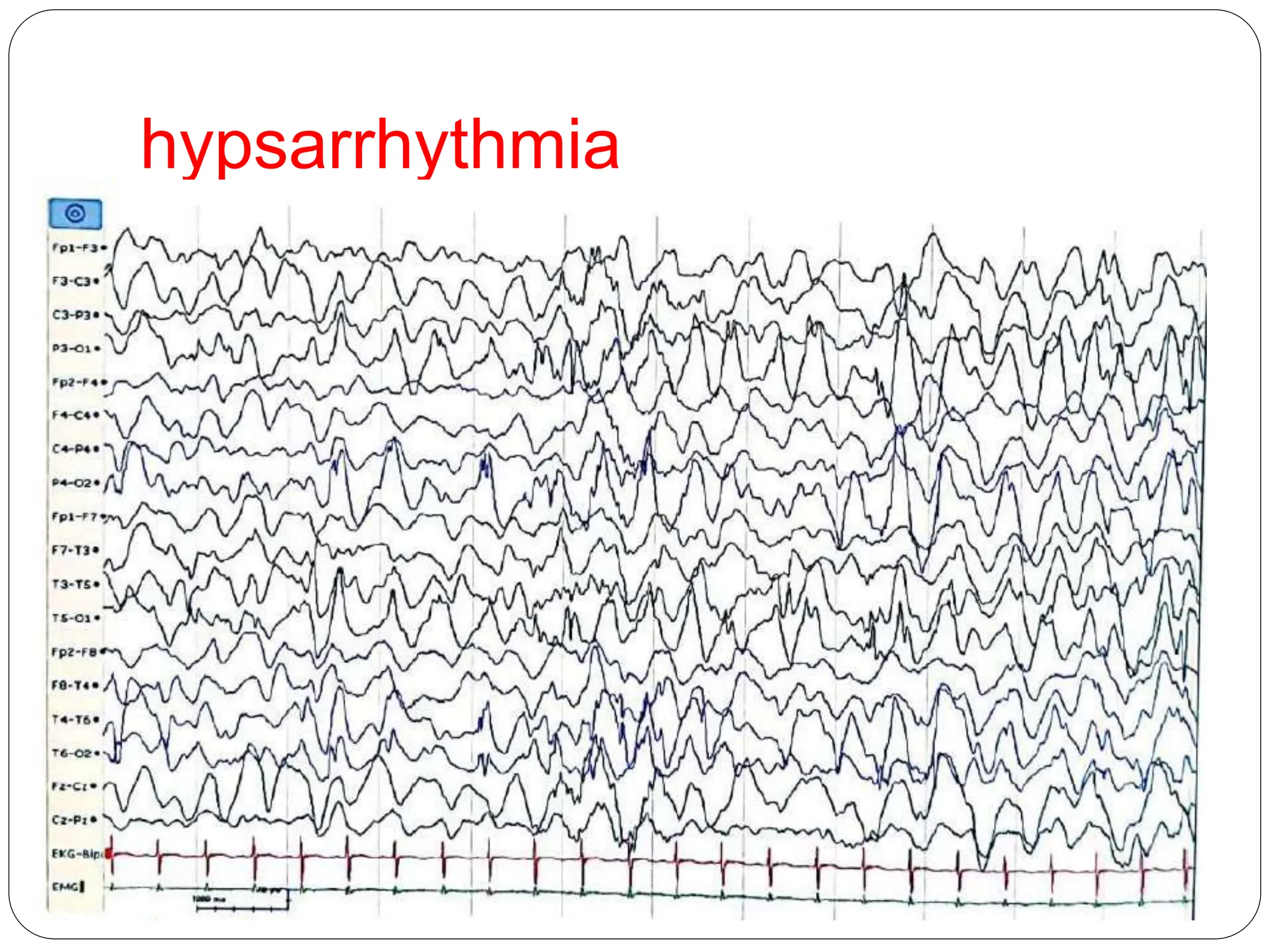 west syndrome ppt hypsarrhythmia infantile.pptx