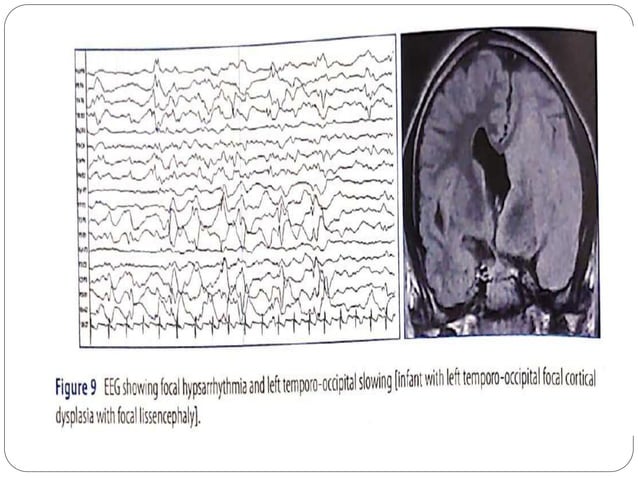 west syndrome ppt hypsarrhythmia infantile.pptx | Brain and Nervous ...