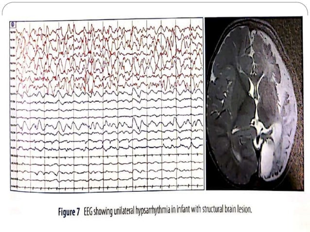 west syndrome ppt hypsarrhythmia infantile.pptx | Brain and Nervous ...