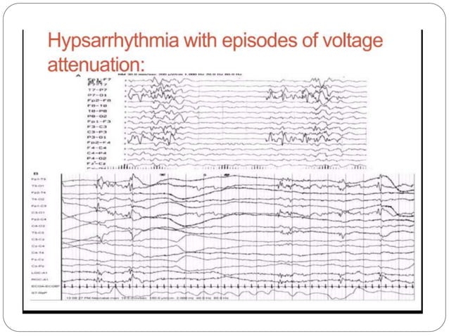 west syndrome ppt hypsarrhythmia infantile.pptx | Brain and Nervous ...