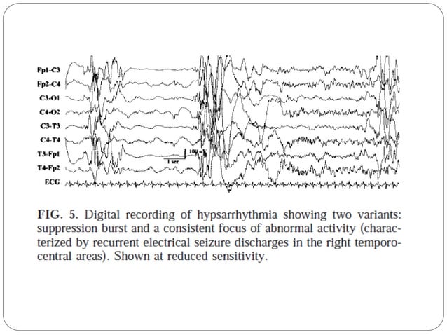 west syndrome ppt hypsarrhythmia infantile.pptx | Brain and Nervous ...