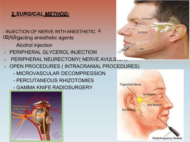 Trigeminal_neuralgia_.pptx