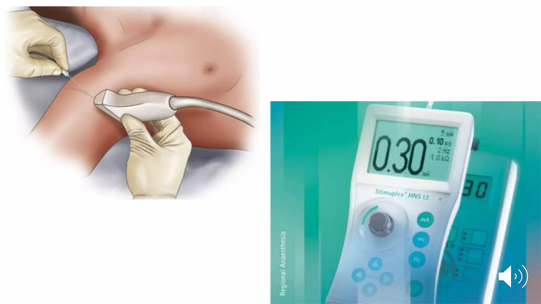 Phenol blocks for spasticity | PPT