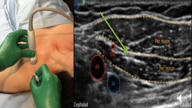 Phenol blocks for spasticity | PPT