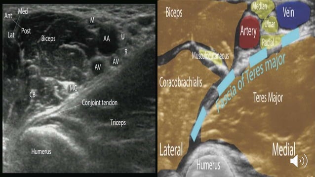 Phenol blocks for spasticity | PPT