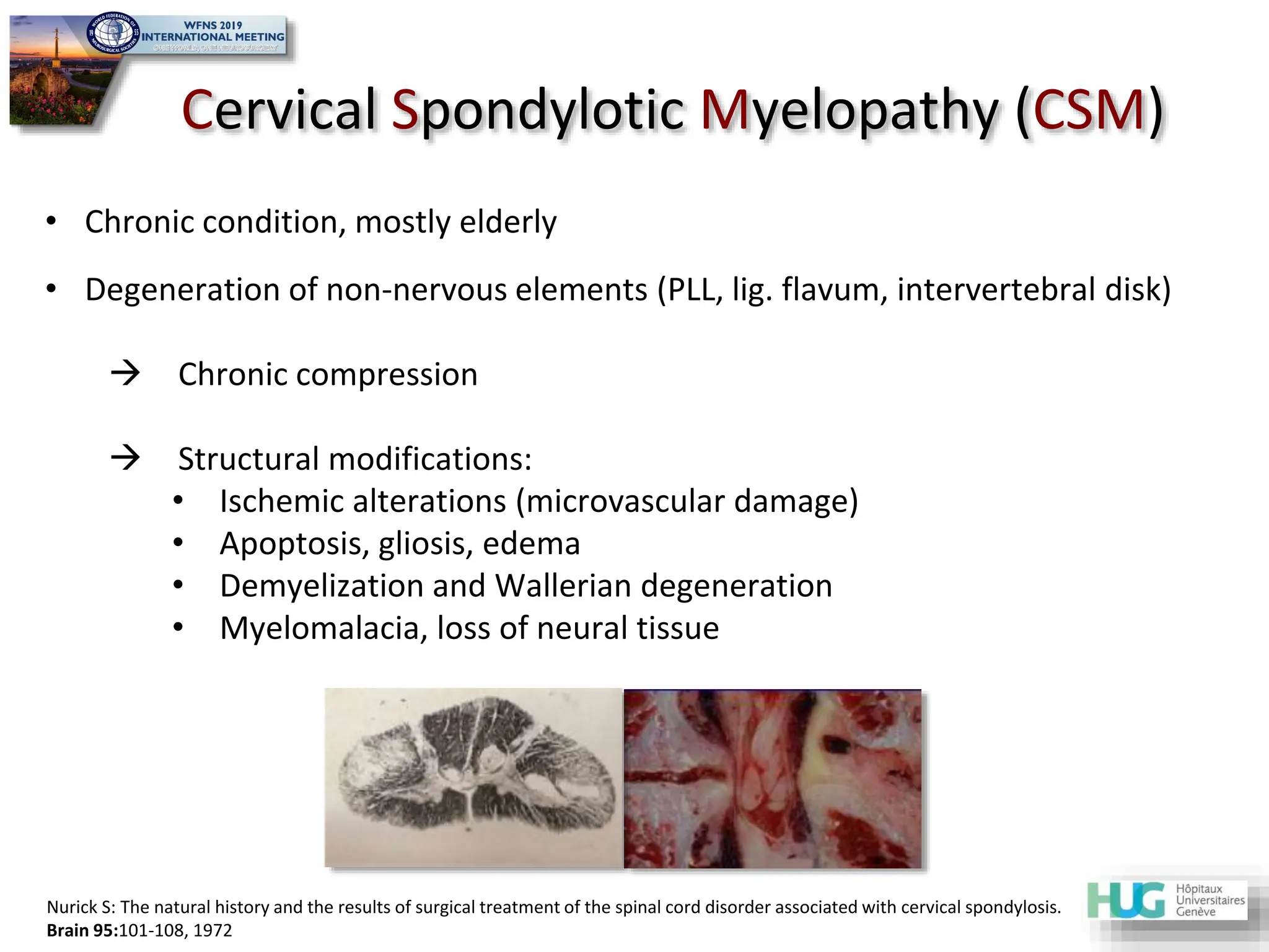 Multidisciplinary approach to patients with cervical myelopathy | PPT