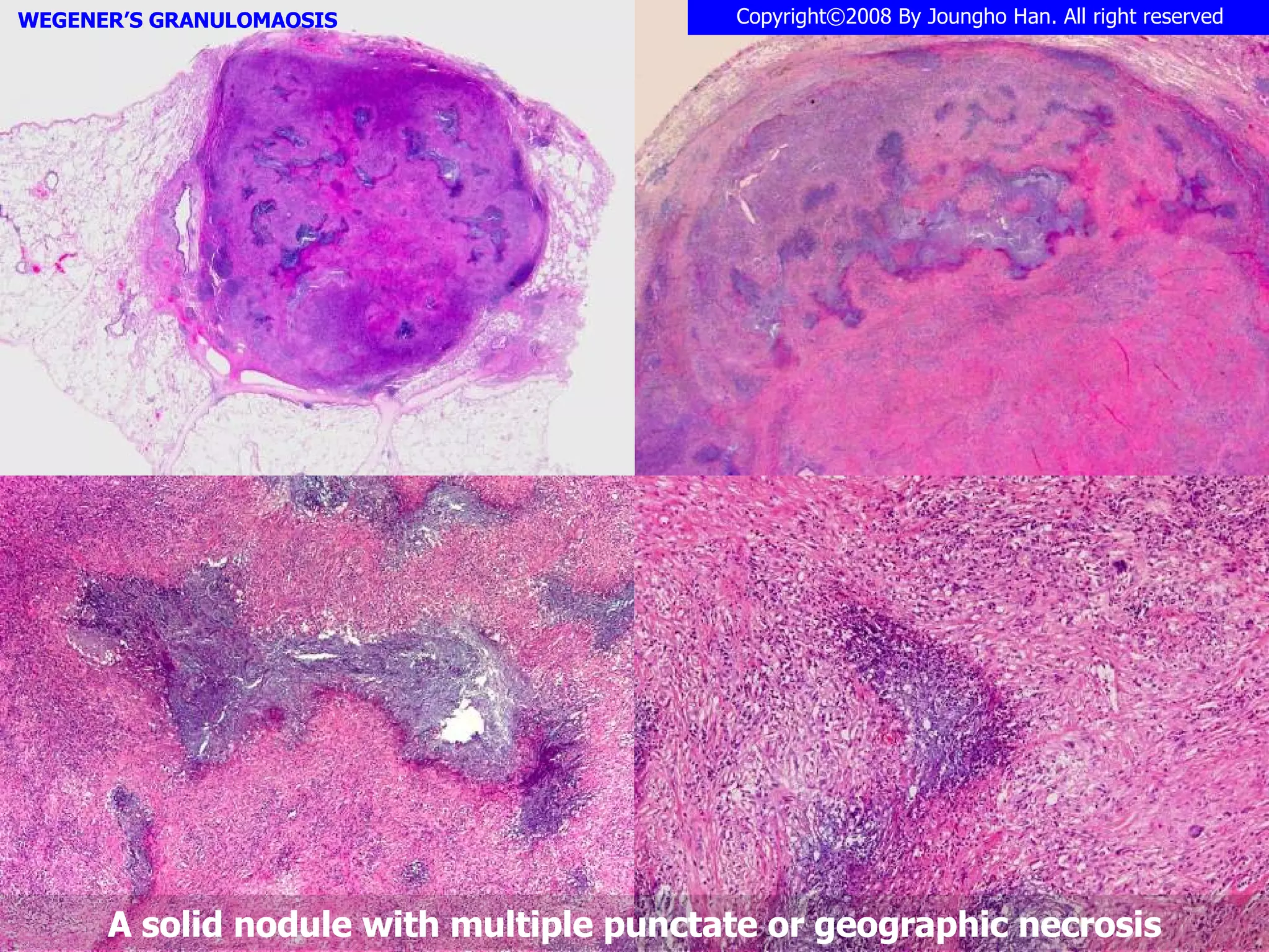 Wegener's granulomatosis, lung | PPS