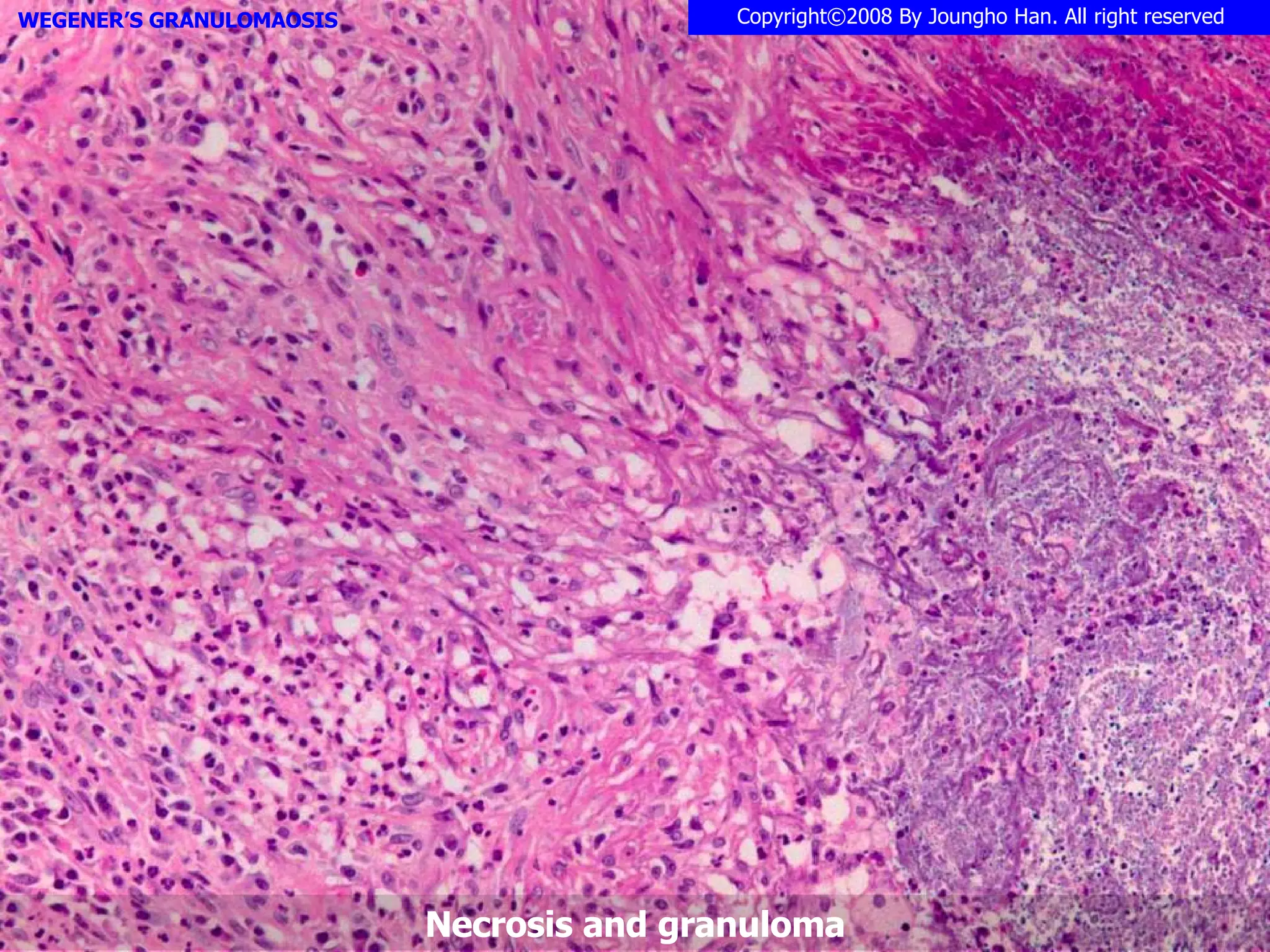 Wegener's granulomatosis, lung | PPS