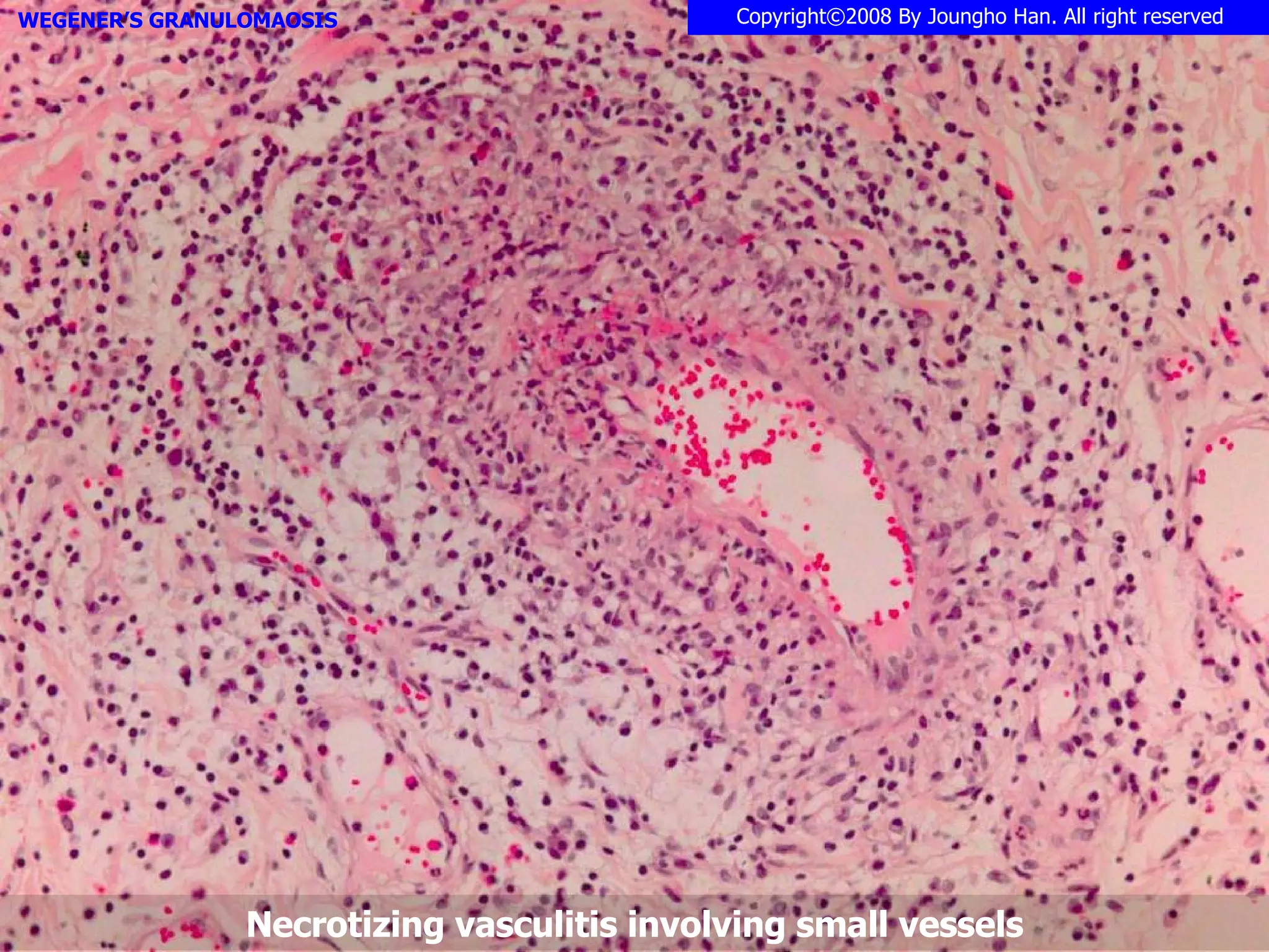 Wegener's granulomatosis, lung | PPS
