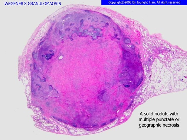 Wegener's granulomatosis, lung | PPS