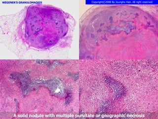Wegener's granulomatosis, lung | PPS