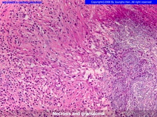 Wegener's granulomatosis, lung | PPS
