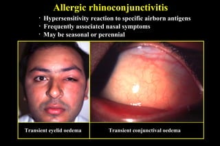 10 allergic conjunctivitis | PPT | Eye and Vision Conditions | Diseases ...