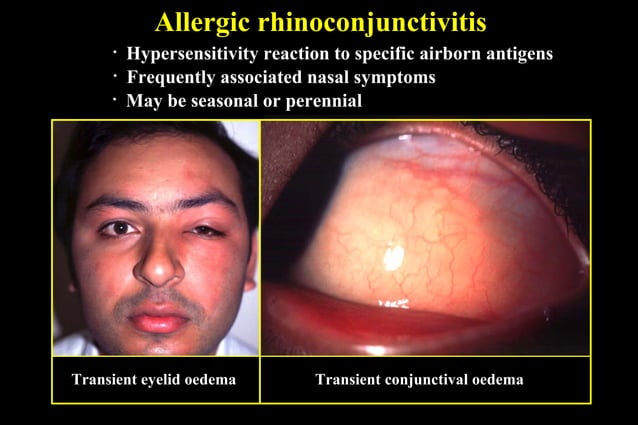 10 allergic conjunctivitis | PPT | Eye and Vision Conditions | Diseases ...