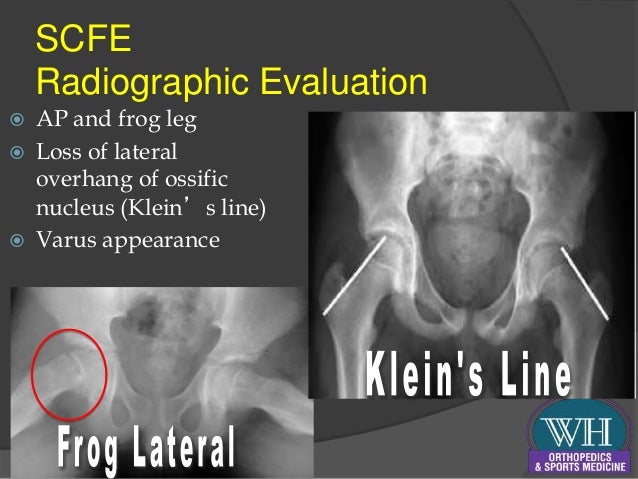 Injuries Unique to the Adolescent Athlete - Westchester Health Orthop…