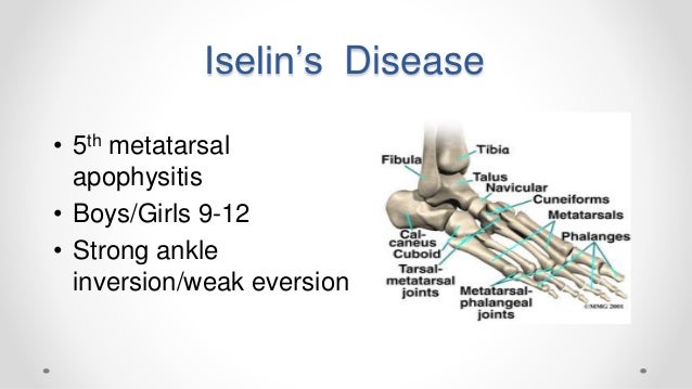 Apophyseal Injuries: Growth Related Musculoskeletal Issues - Westches…