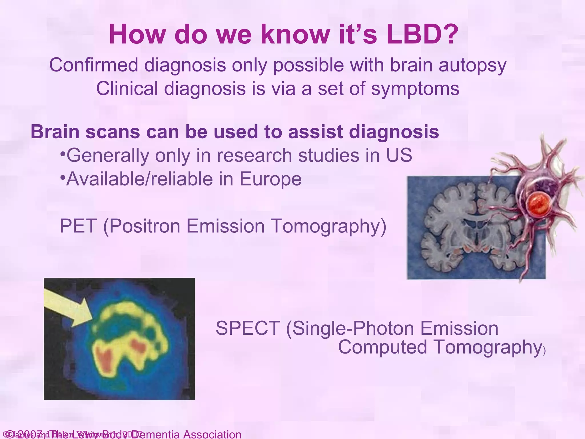 What Is Lewy Body Dementia | PPT