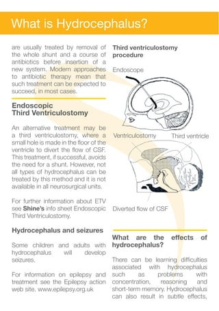 What is Hydrocephalus? | PDF