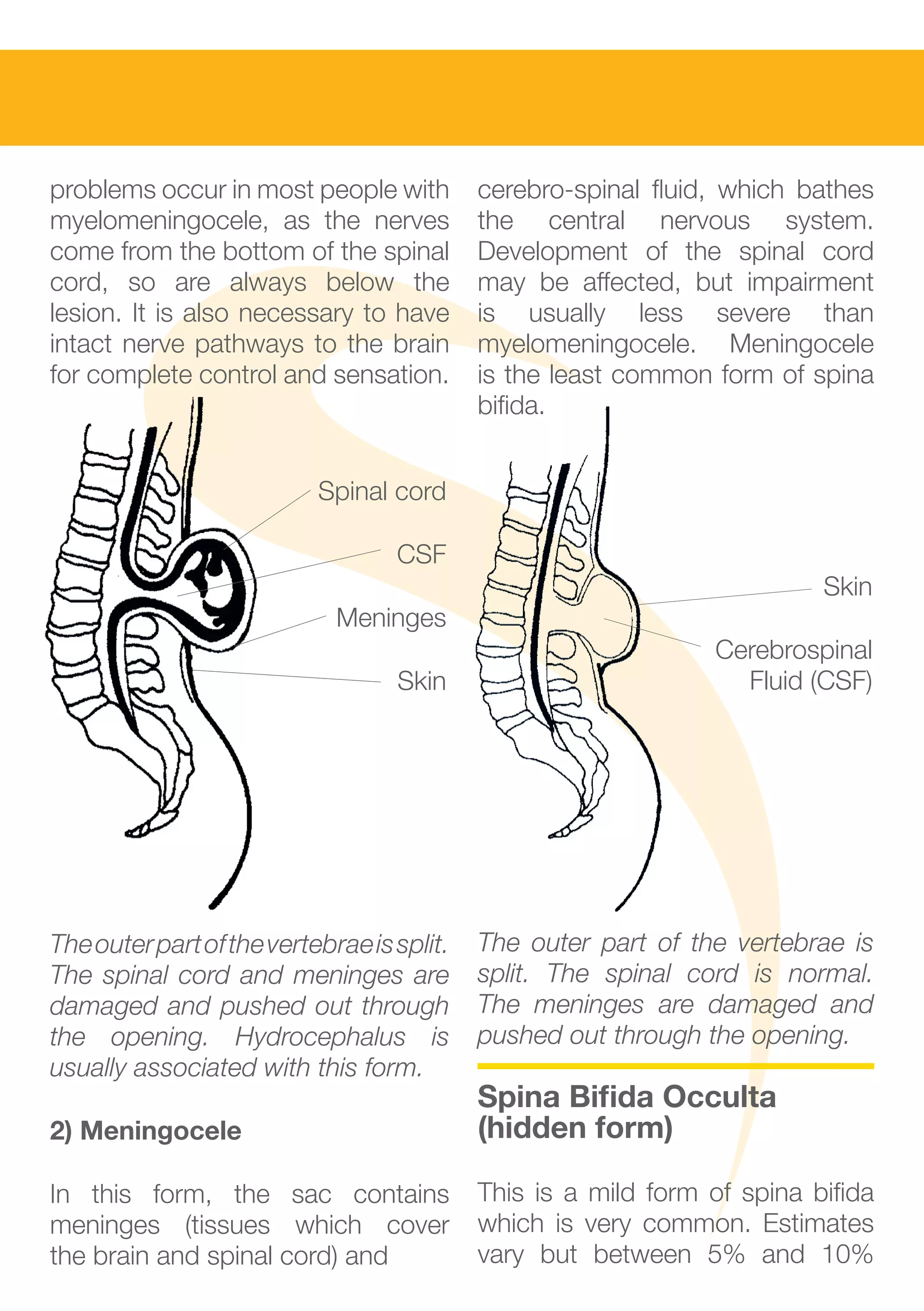 What is spina bifida | PDF