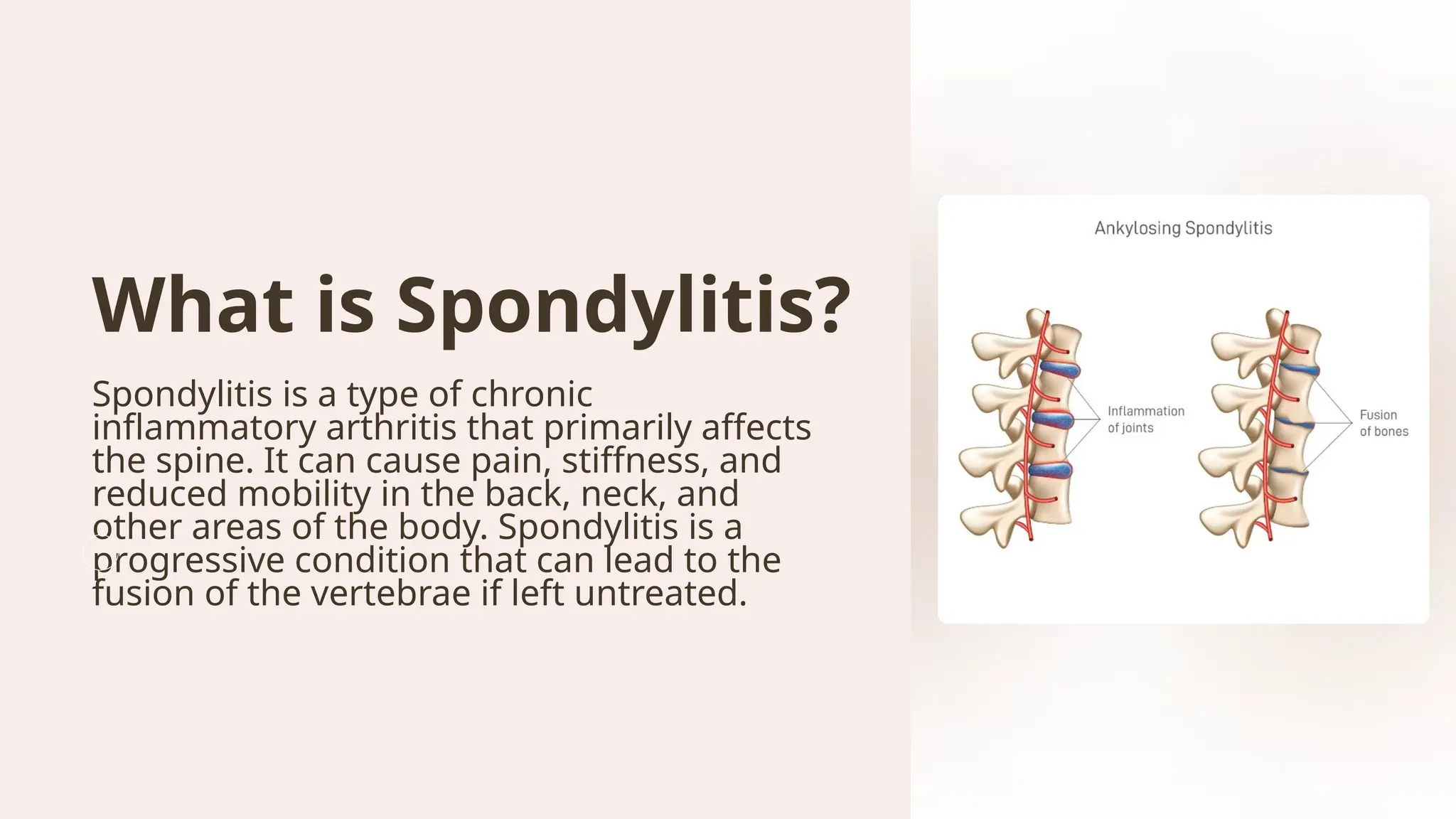 What is Spondylitis : introduction and overview | PPTX