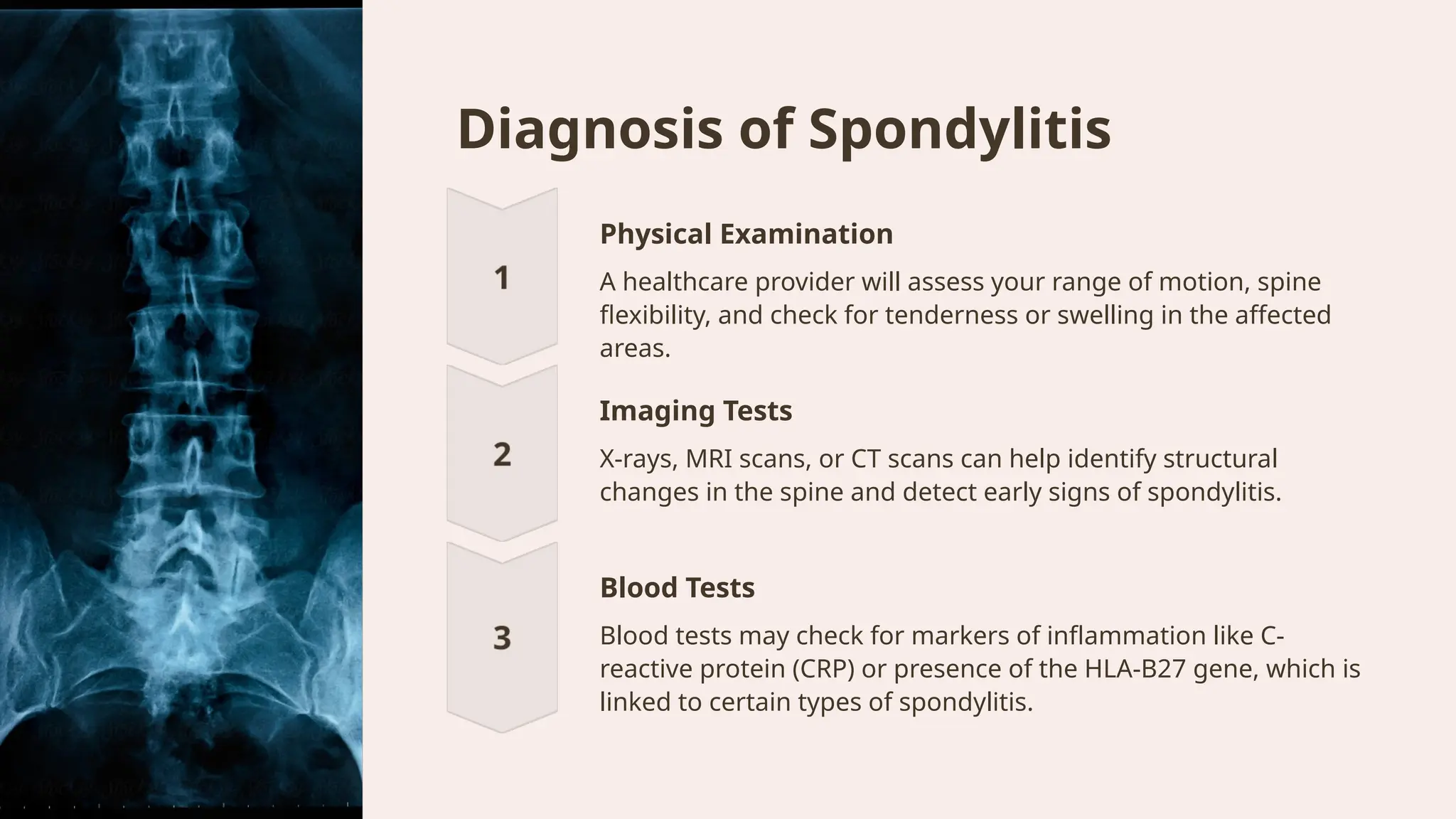 What is Spondylitis : introduction and overview | PPTX