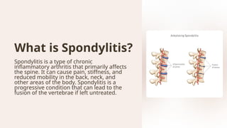 What is Spondylitis : introduction and overview | PPTX