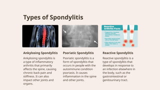 What is Spondylitis : introduction and overview | PPTX