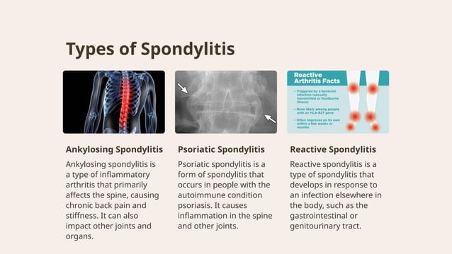 What is Spondylitis : introduction and overview | PPT