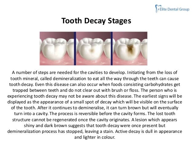 What tooth-decay-know-about-symptoms-causes