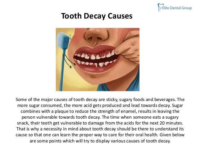 What tooth-decay-know-about-symptoms-causes