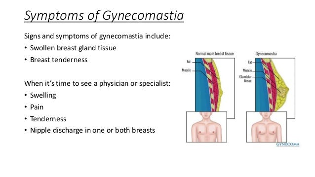 What you need to know about gynecomastia