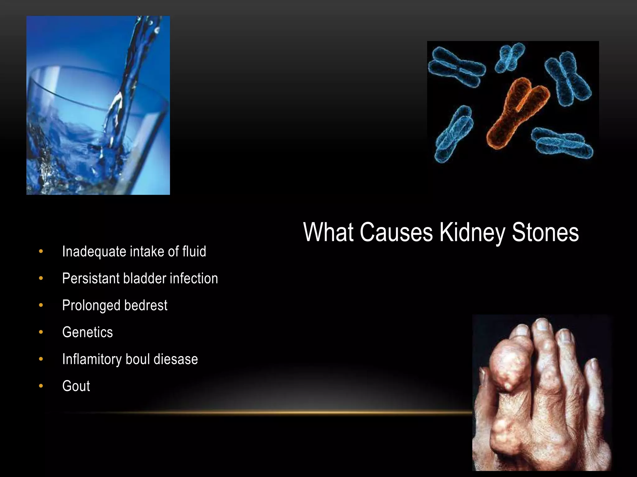 What are kidney stones | PPTX