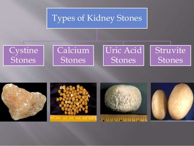 What are kidney stones