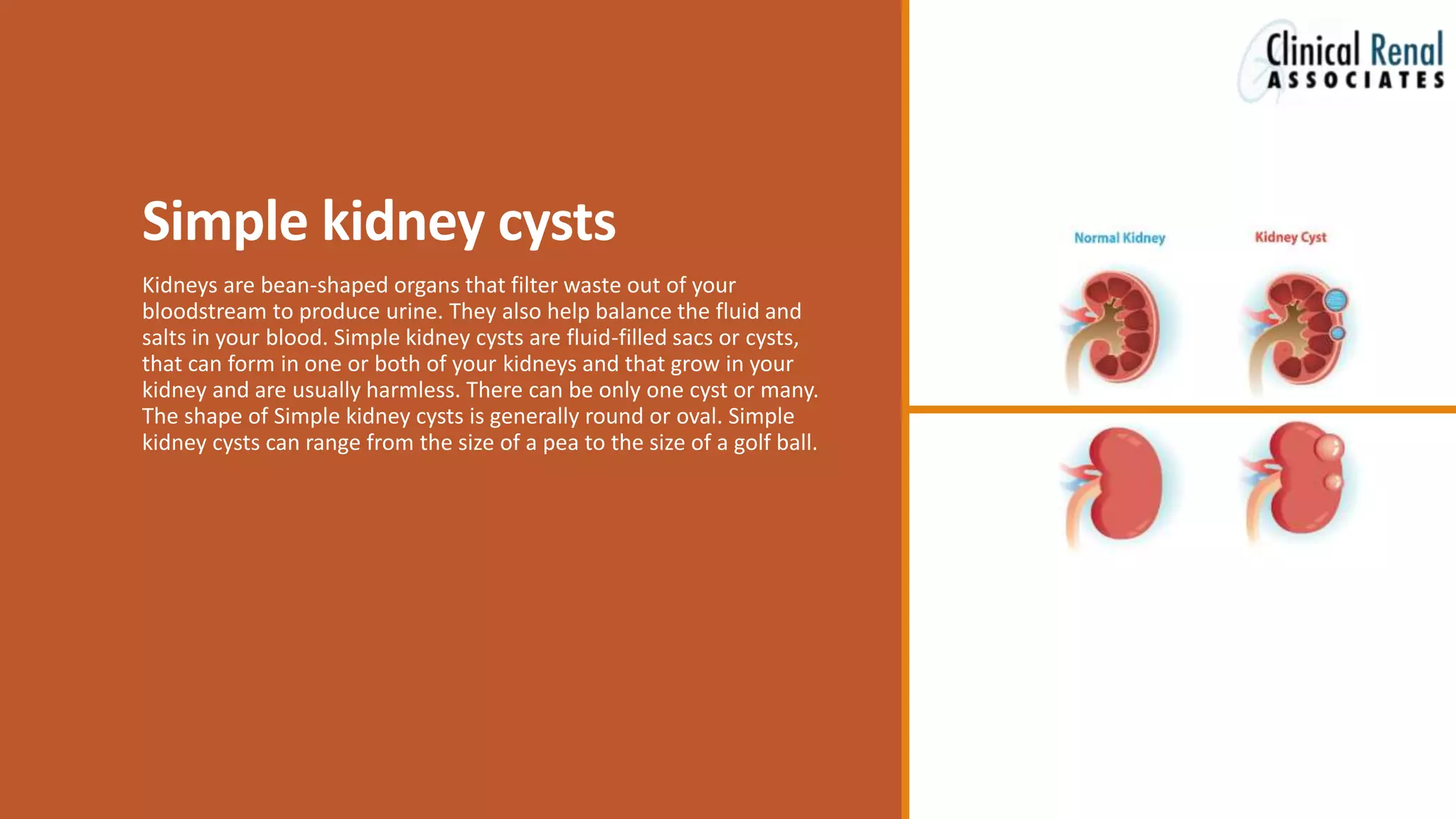 What are simple kidney cysts.pptx