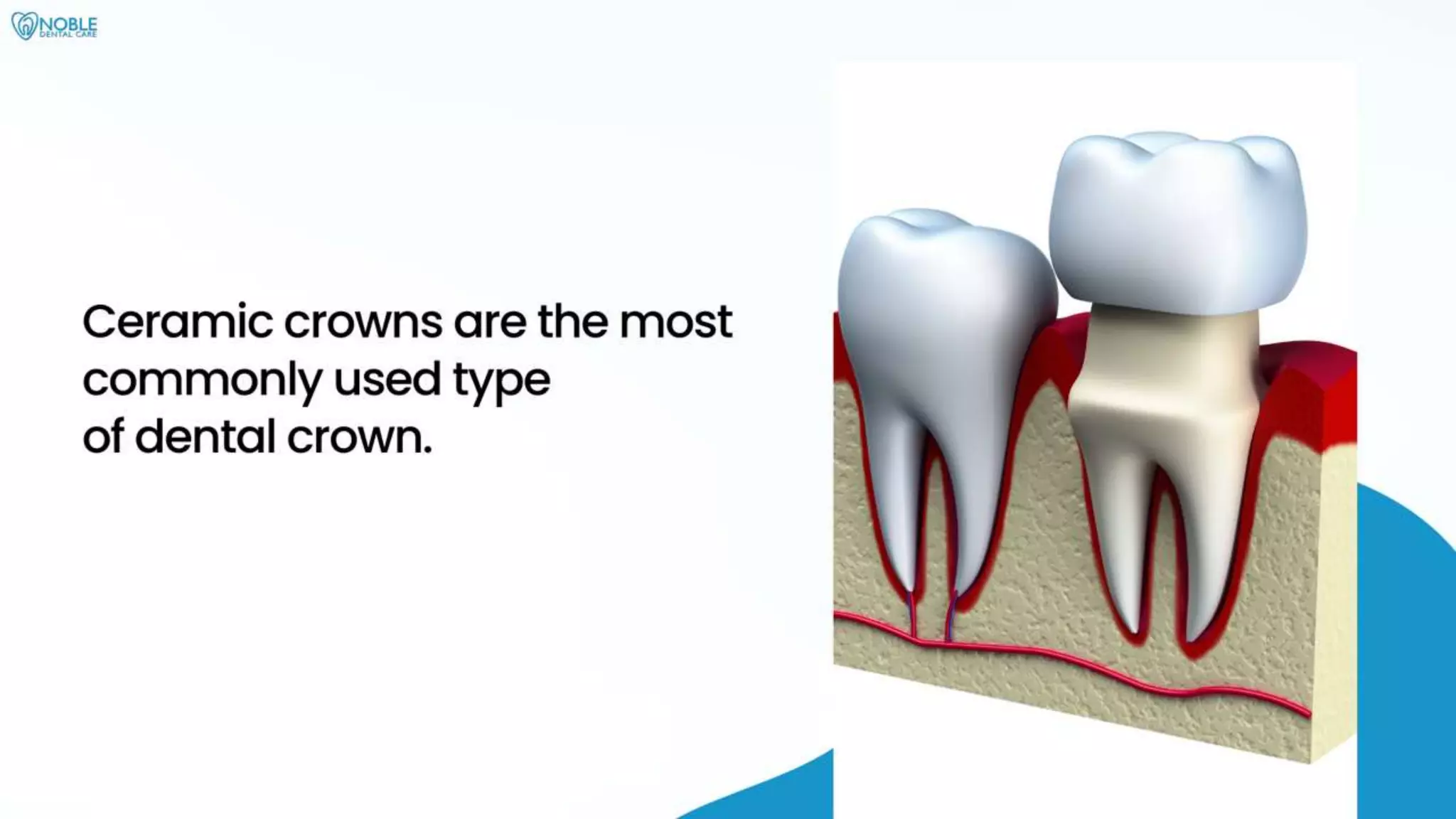What are the Different Types of Dental Crowns.pptx
