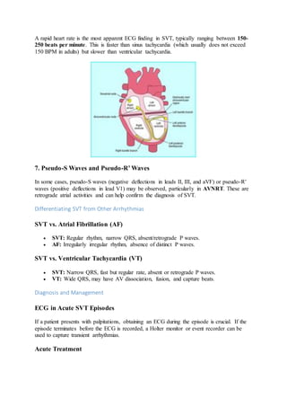What Are the Key ECG Findings in Supraventricular Tachycardia? | PDF