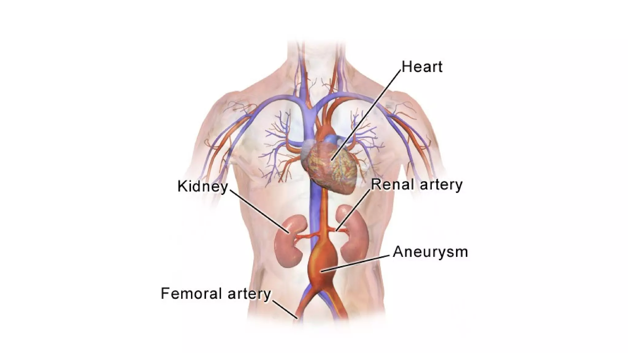 What Are The Signs And Symptoms Of An Abdominal Aortic Aneurysm? | PPT