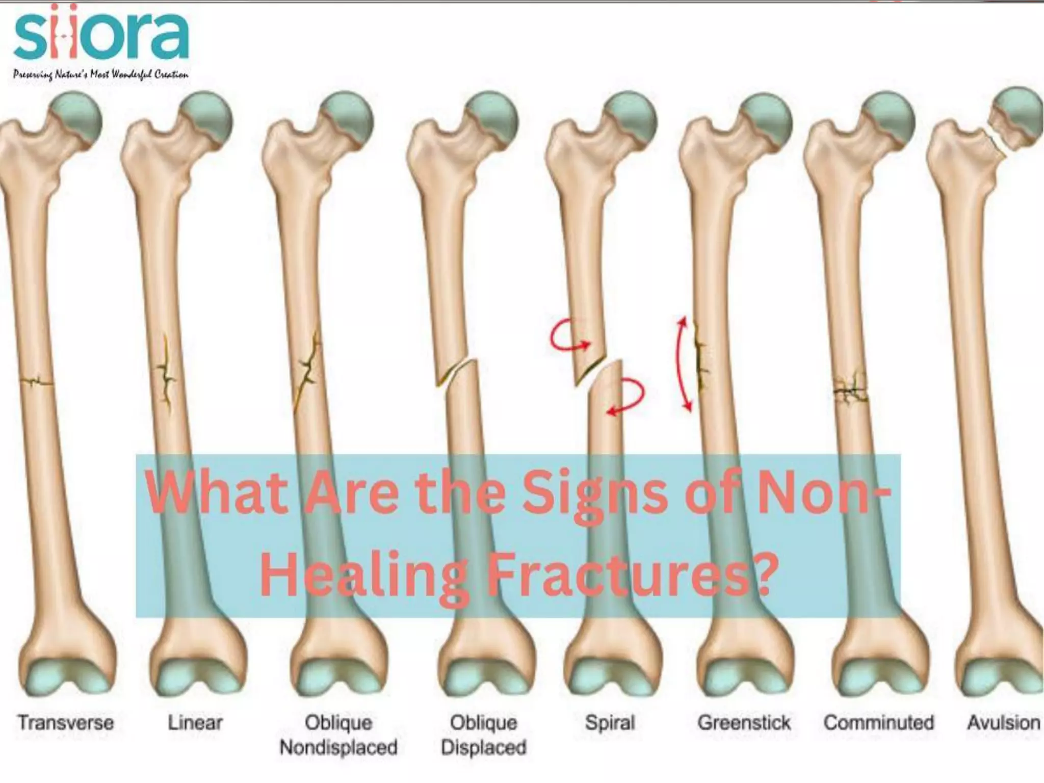 What Are the Signs of Non-Healing Fractures? | PPT