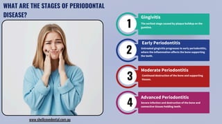 What Are the Stages of Periodontal Disease.pdf