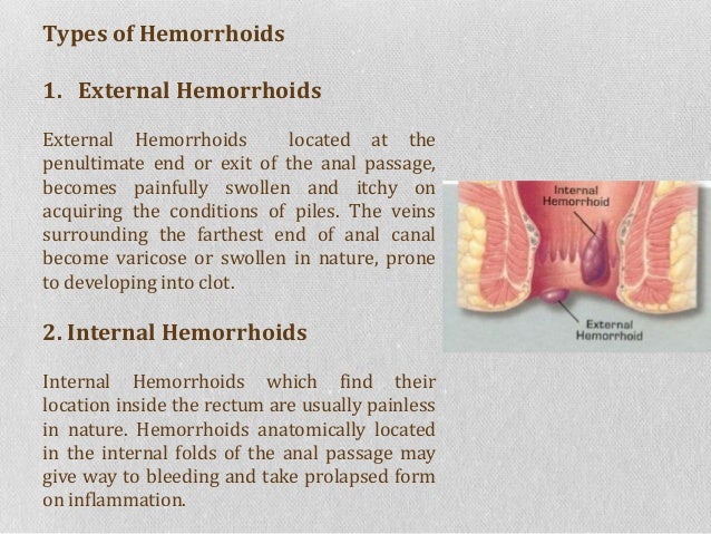 What are the treatment options for piles