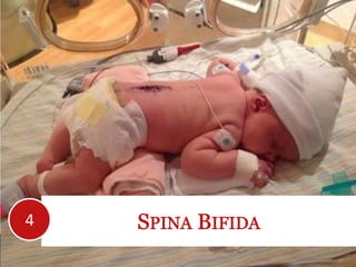 What Birth Defects Do SSRIs Cause? | PDF