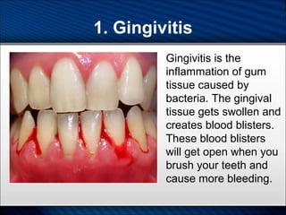 What causes bleeding gums | PPT