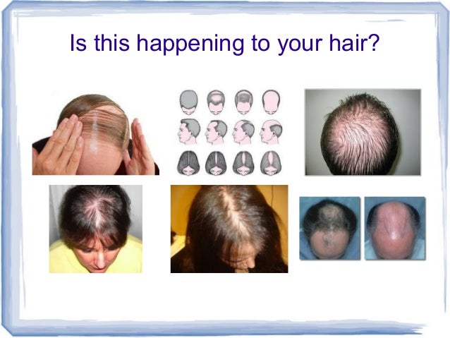 What Causes Hair Loss And How To Prevent It