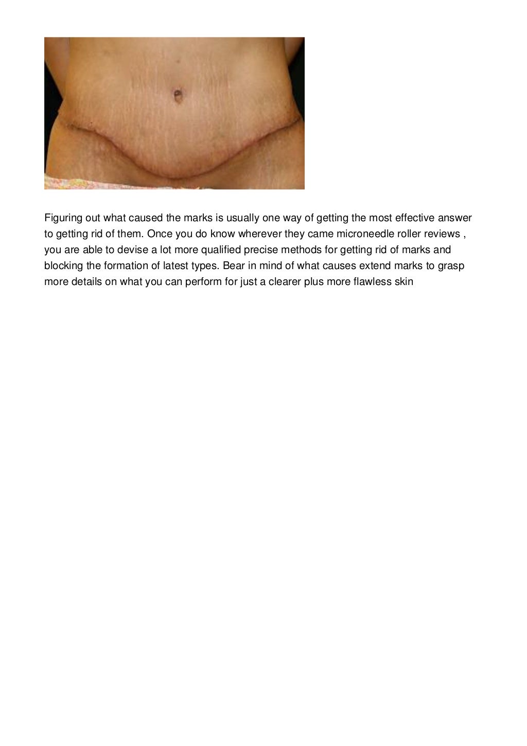 What Do Stretch Marks Mean what-do-stretch-marks-mean